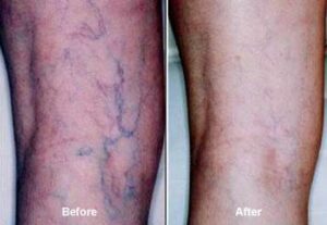 Varicose Vein | Everything You Need To Know | Techno FAQ